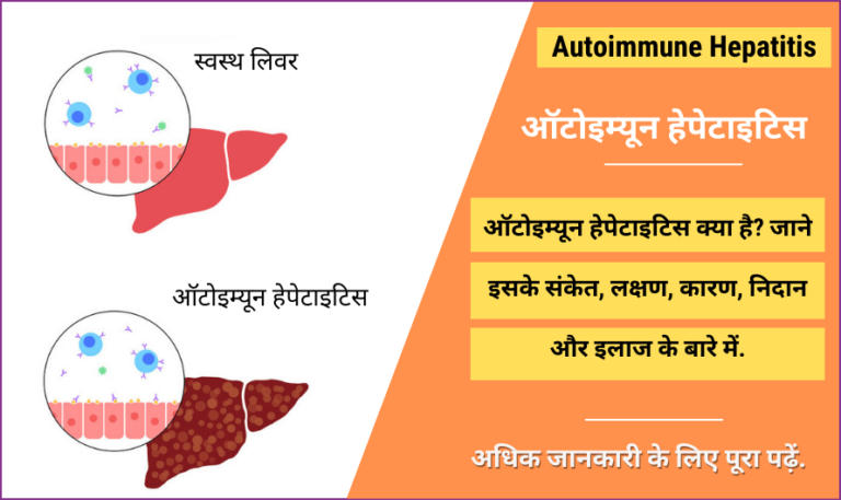 ऑटोइम्यून हेपेटाइटिस - Autoimmune Hepatitis in Hindi, Symptoms